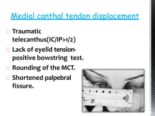 NOE FRACTURE PPT | PPTX