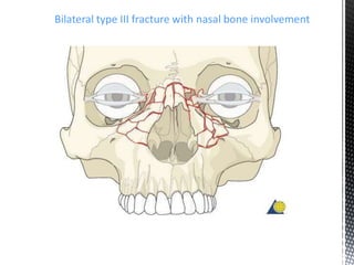 NOE FRACTURE PPT | PPTX