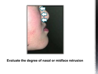 NOE FRACTURE PPT | PPTX