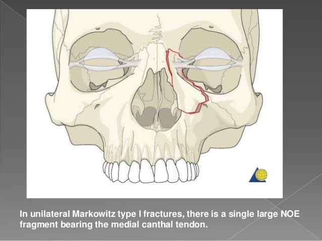 Naso orbito ethmoidal fracture