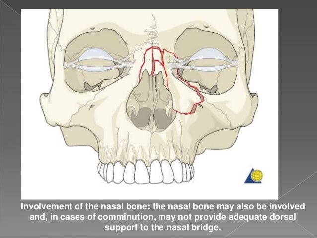 Naso orbito ethmoidal fracture