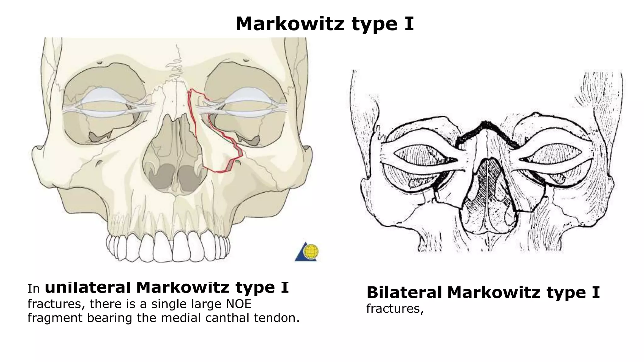 Naso orbito ethmoid (noe) complex fracture | PPTX