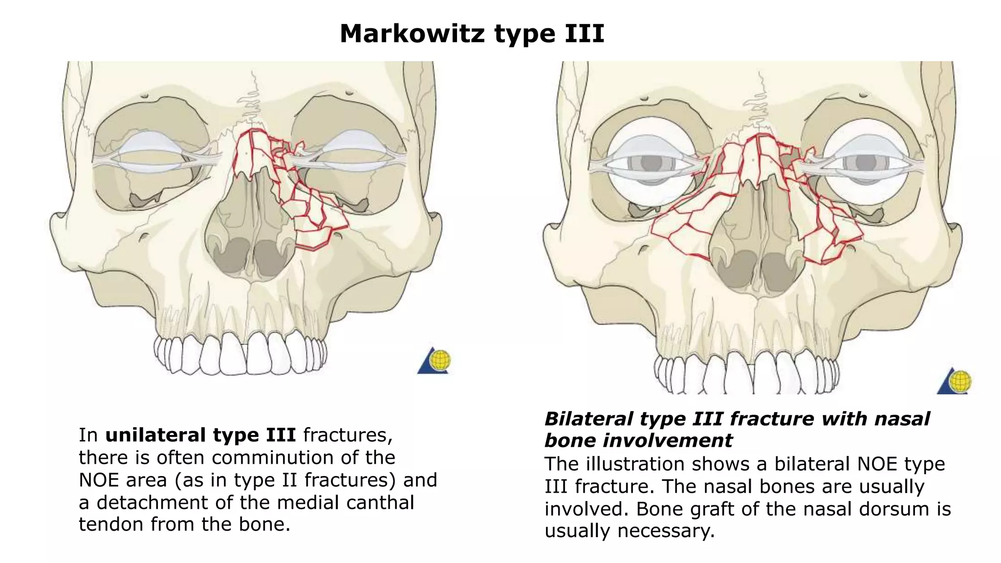 Naso orbito ethmoid (noe) complex fracture | PPTX