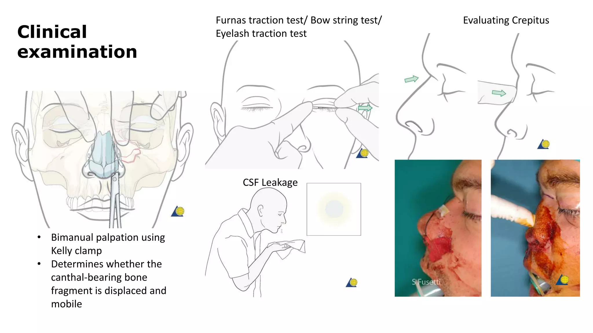 Naso orbito ethmoid (noe) complex fracture | PPTX