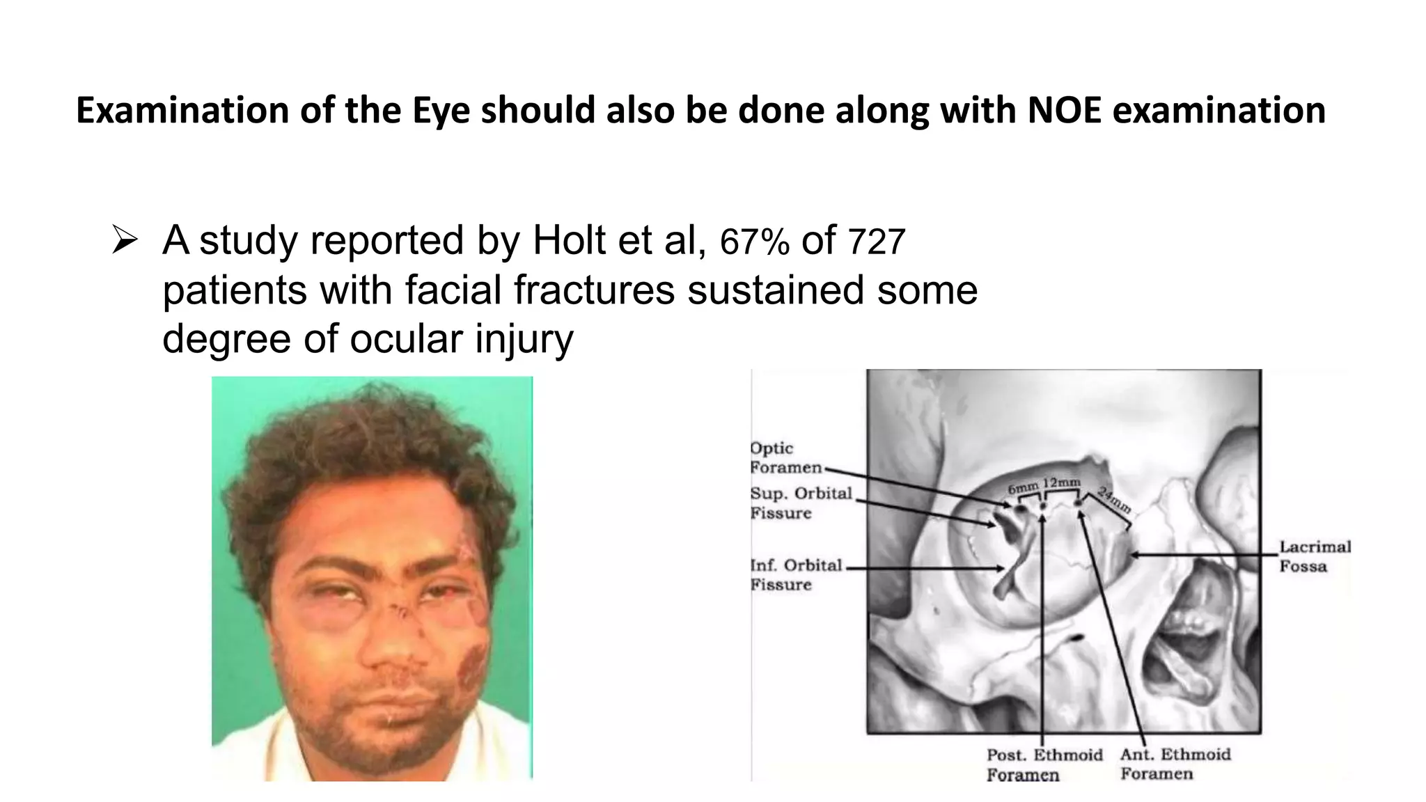 Naso orbito ethmoid (noe) complex fracture | PPTX