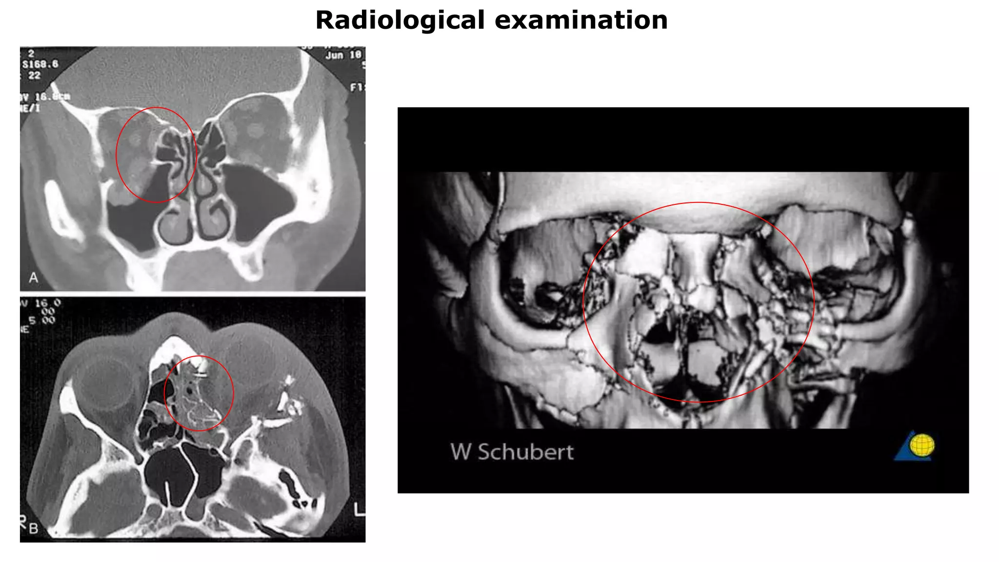 Naso orbito ethmoid (noe) complex fracture | PPTX