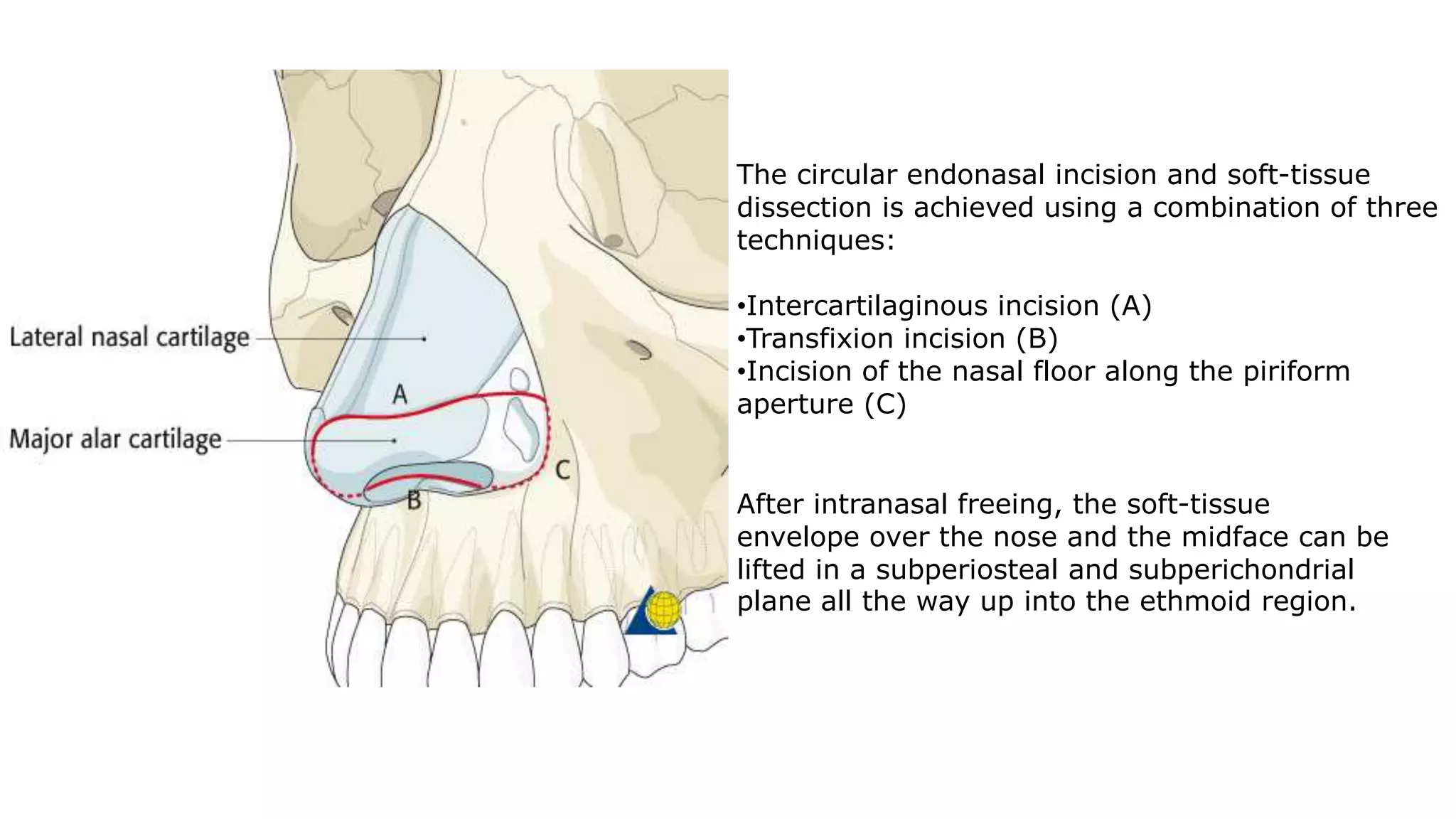 Naso orbito ethmoid (noe) complex fracture | PPTX