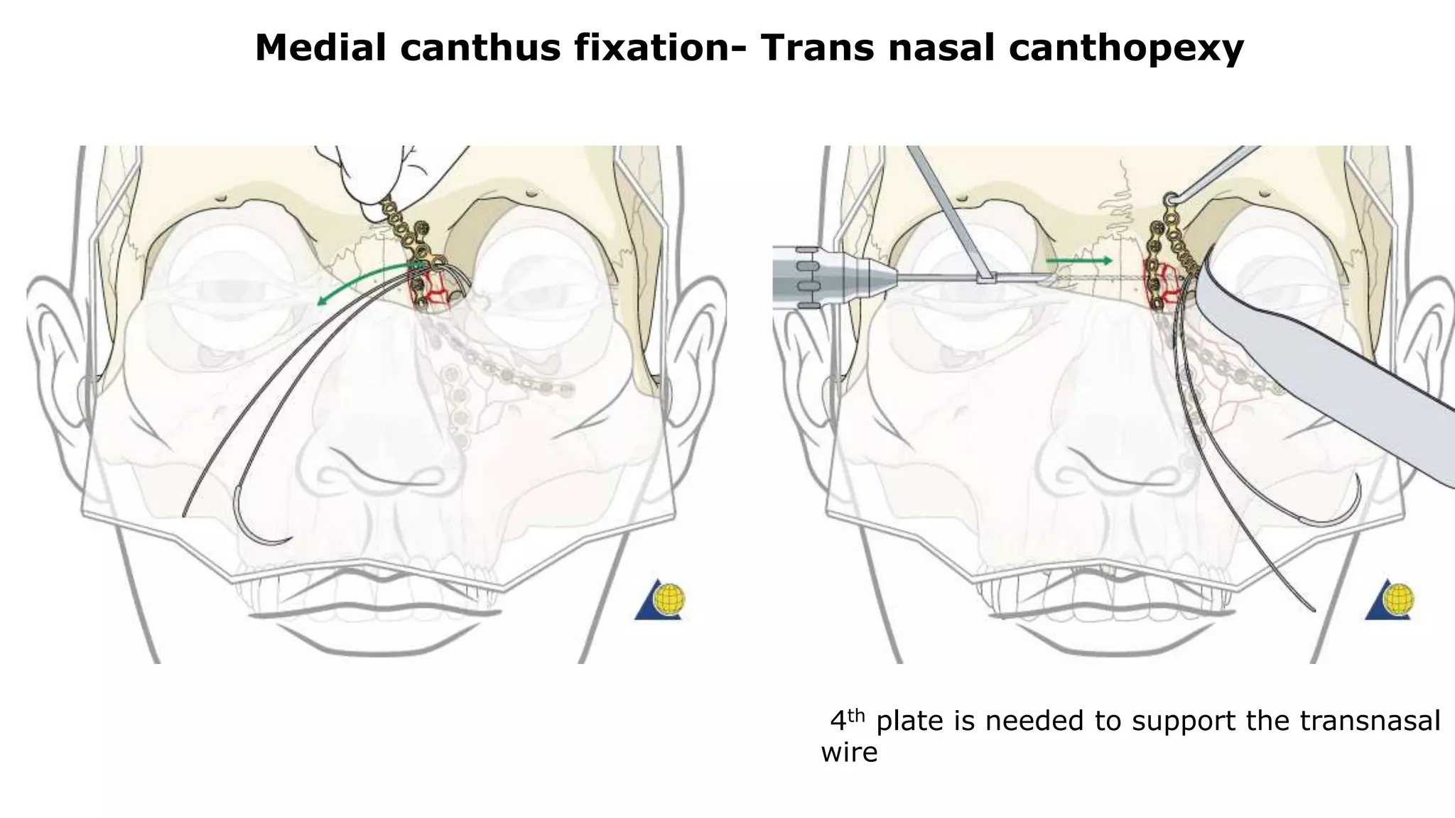 Naso orbito ethmoid (noe) complex fracture | PPTX