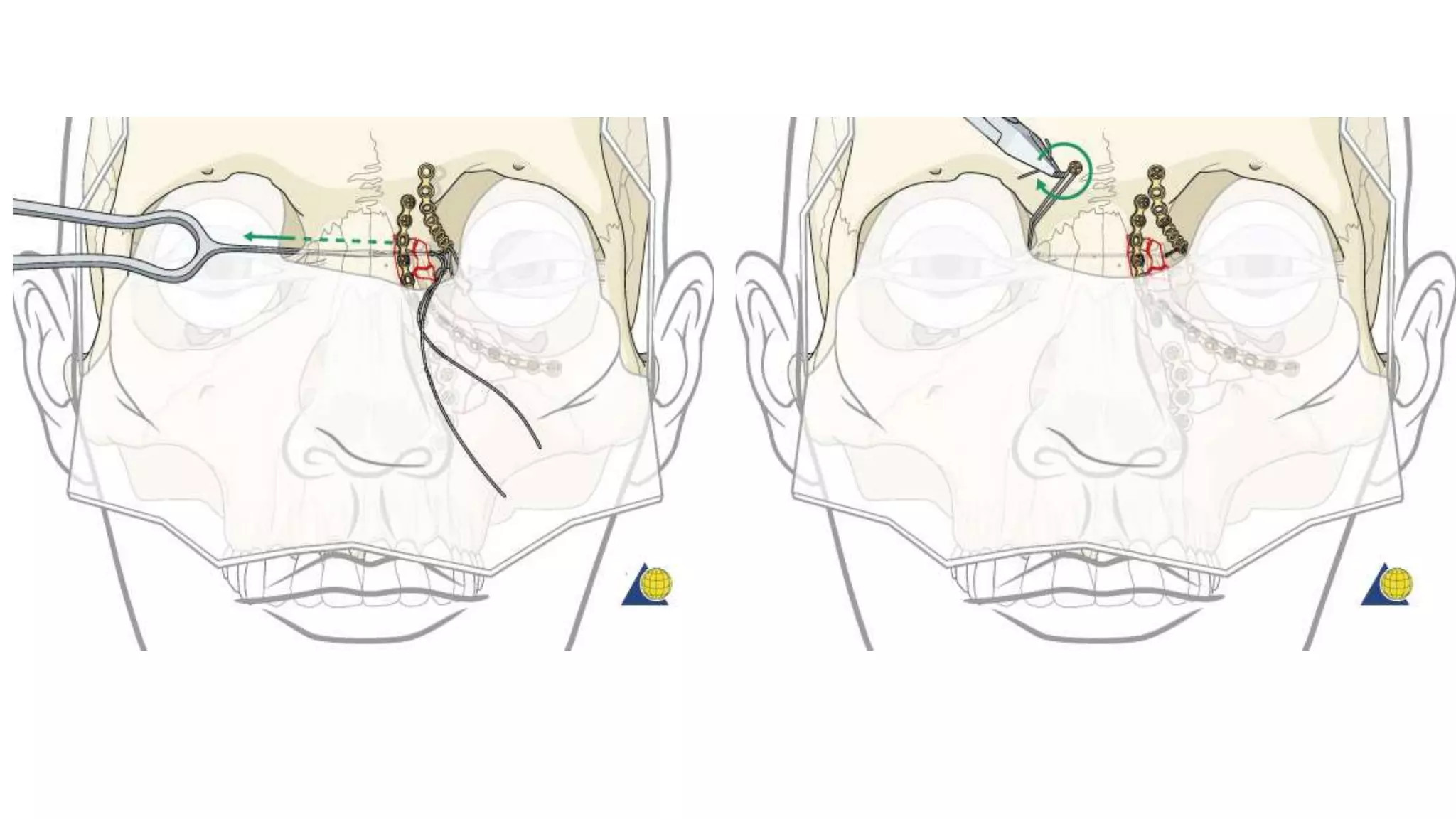 Naso orbito ethmoid (noe) complex fracture | PPTX