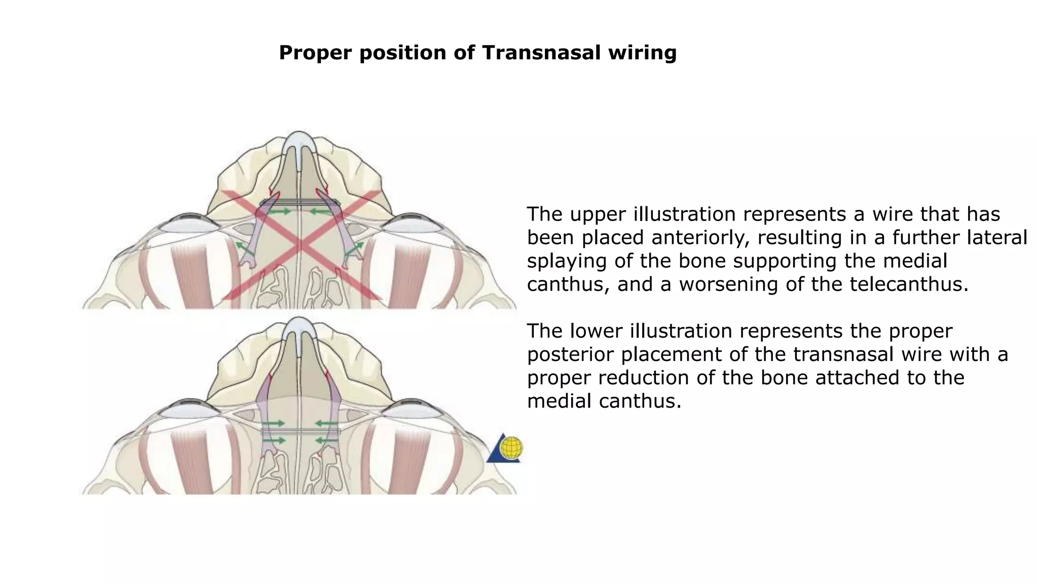 Naso orbito ethmoid (noe) complex fracture | PPTX