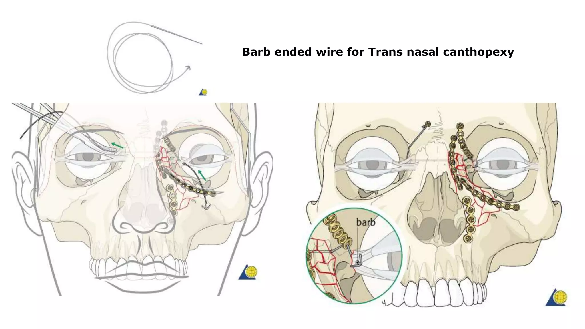 Naso orbito ethmoid (noe) complex fracture | PPTX