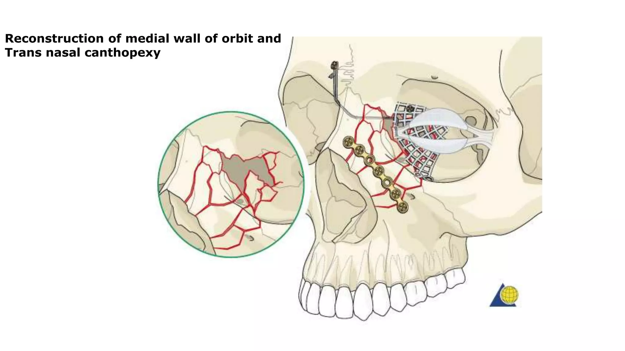 Naso orbito ethmoid (noe) complex fracture | PPTX