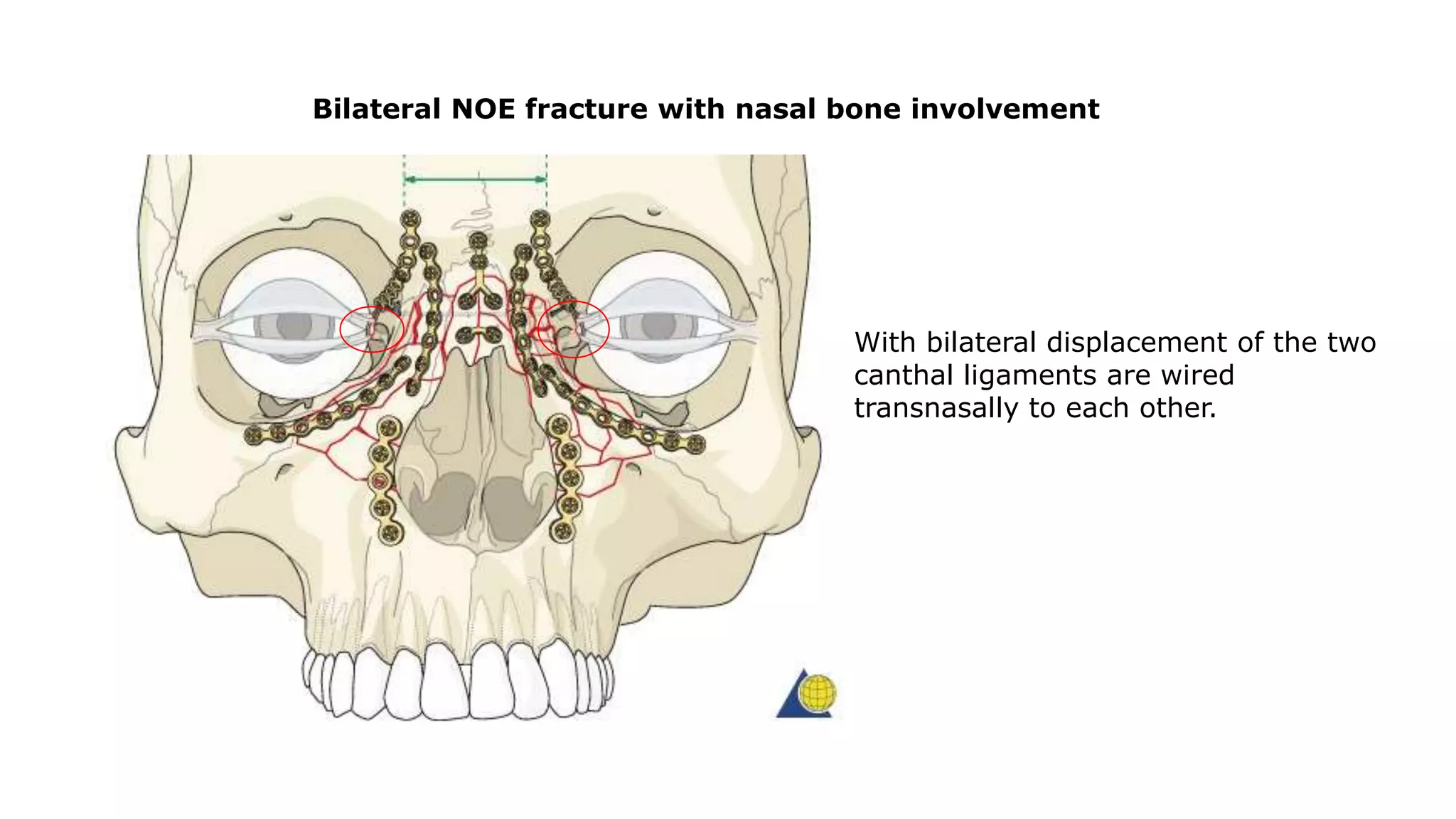 Naso orbito ethmoid (noe) complex fracture | PPTX