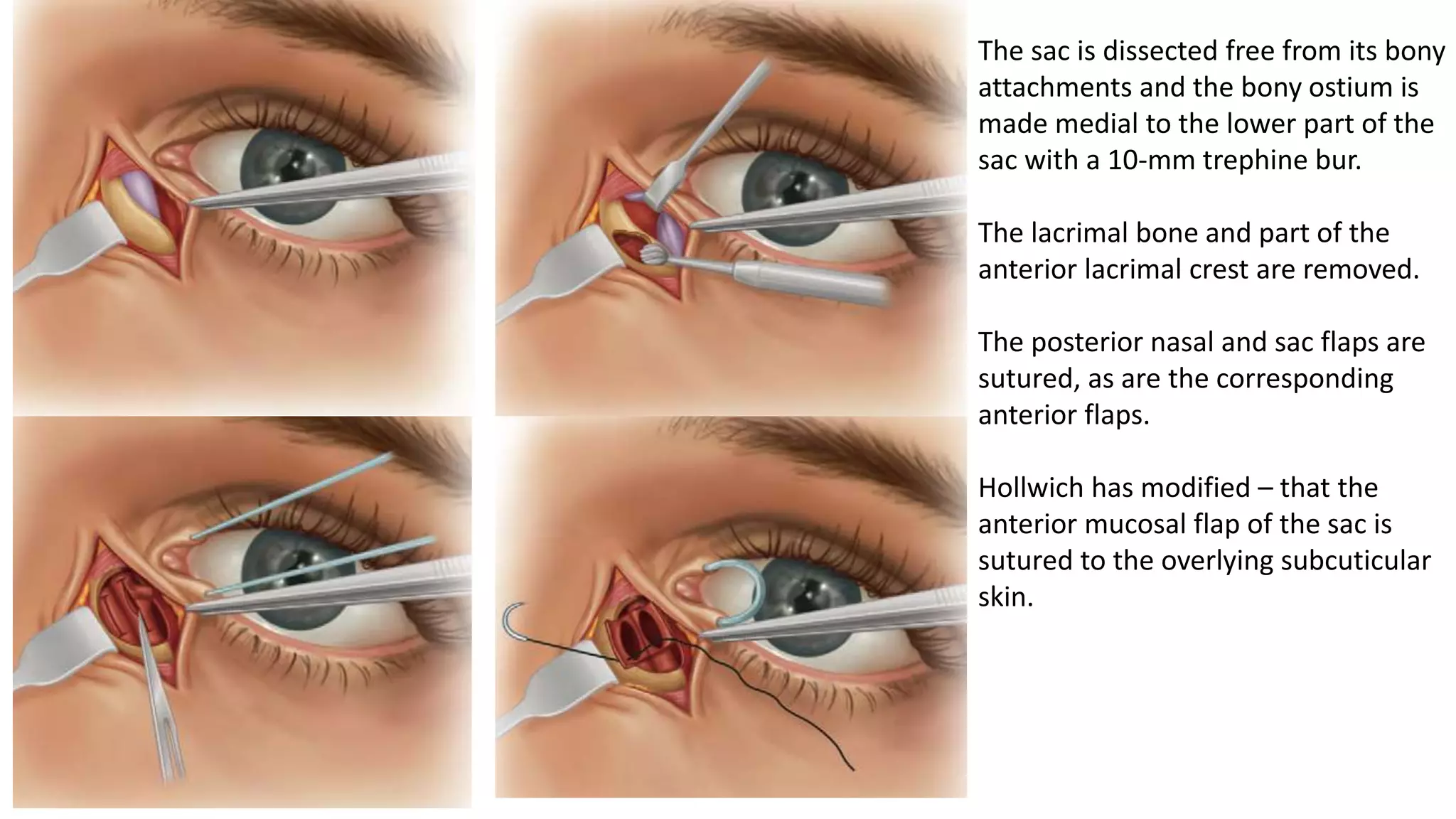 Naso orbito ethmoid (noe) complex fracture | PPTX