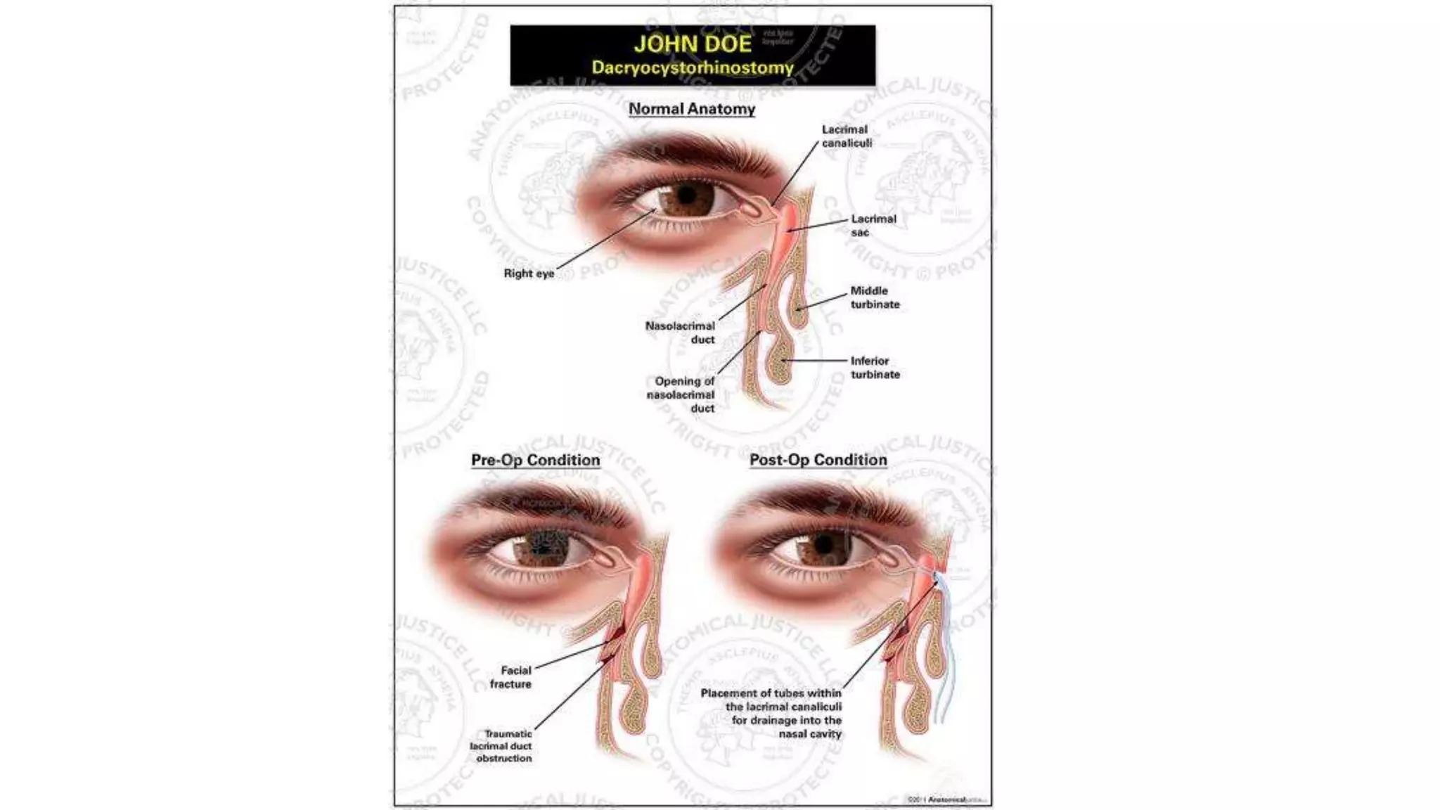 Naso orbito ethmoid (noe) complex fracture | PPTX