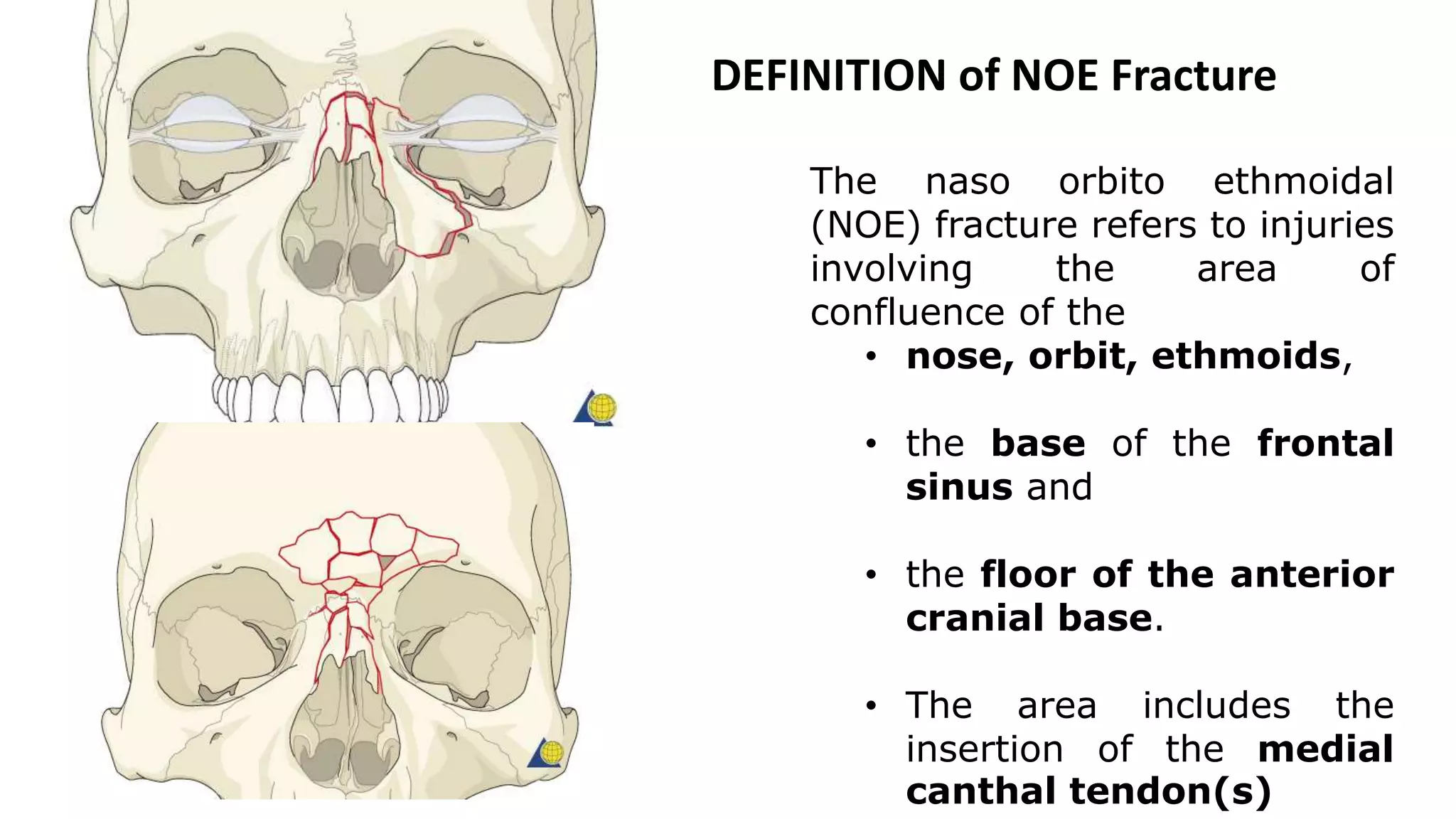 Naso orbito ethmoid (noe) complex fracture | PPTX