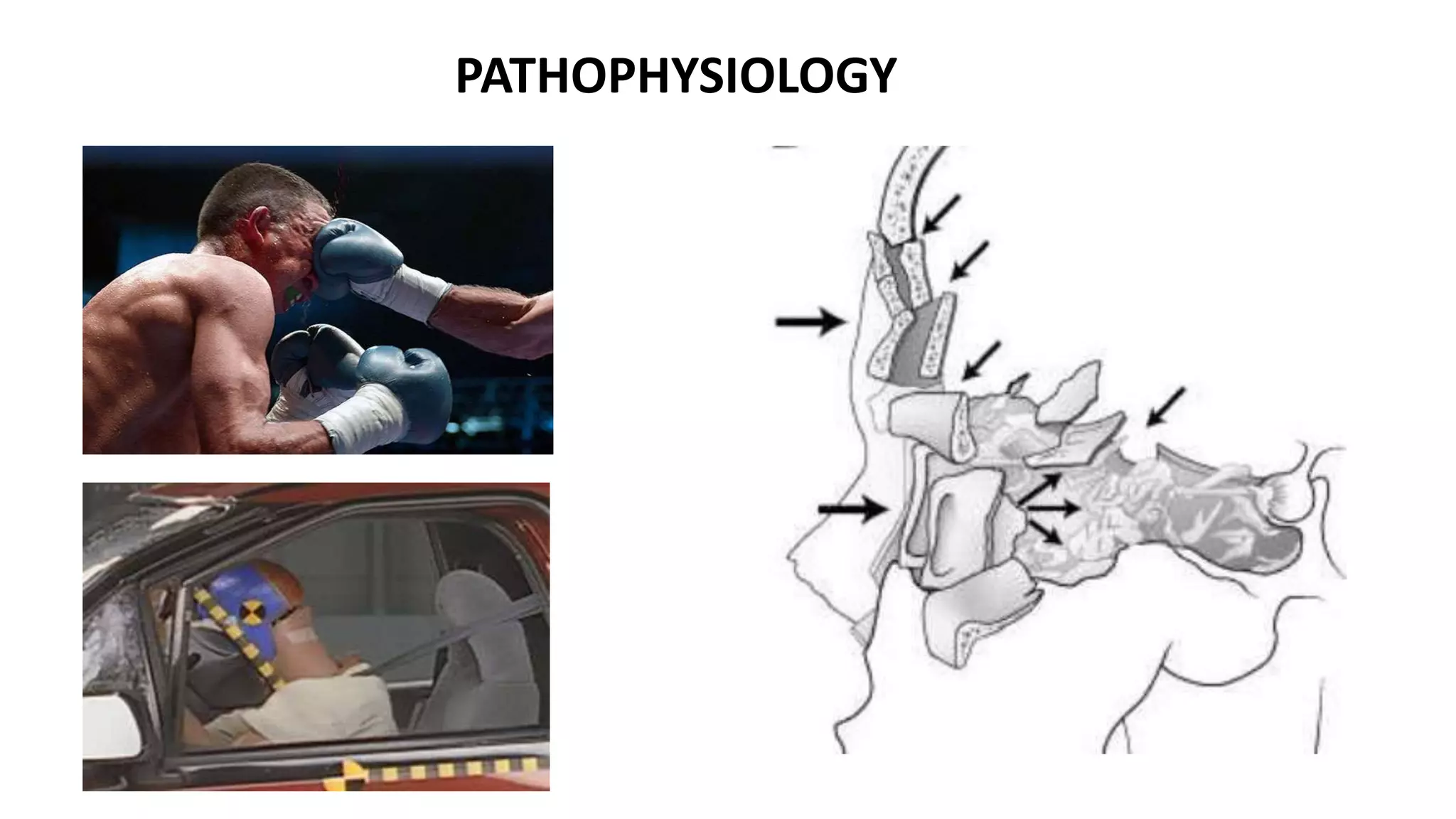 Naso orbito ethmoid (noe) complex fracture | PPTX