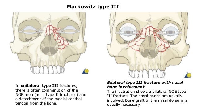 Naso orbito ethmoid (noe) complex fracture