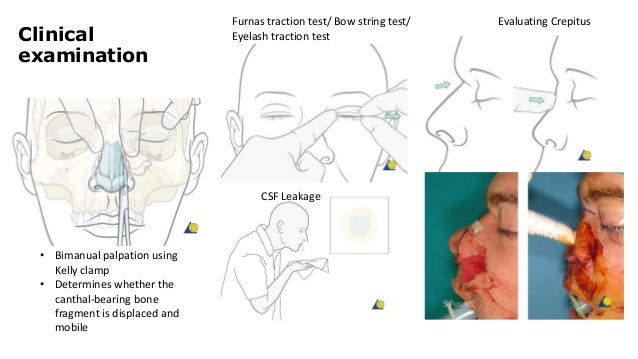 Naso orbito ethmoid (noe) complex fracture