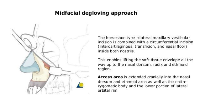 Naso orbito ethmoid (noe) complex fracture