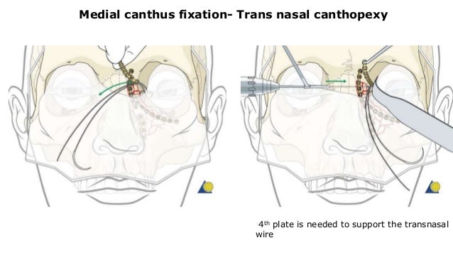 Naso orbito ethmoid (noe) complex fracture