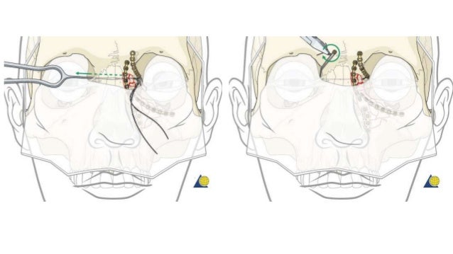 Naso orbito ethmoid (noe) complex fracture
