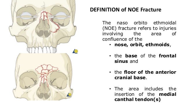 Naso orbito ethmoid (noe) complex fracture