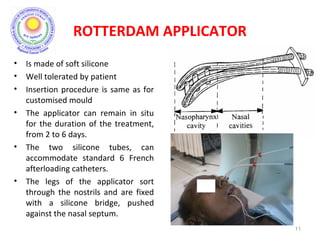 Nasopharyngeal brachytherapy | PPT