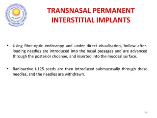 Nasopharyngeal brachytherapy | PPT
