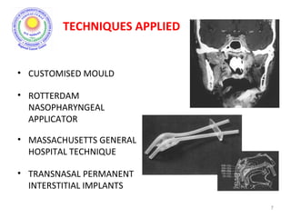 Nasopharyngeal brachytherapy | PPT