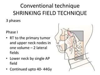Nasopharyngeal cancer | PPTX