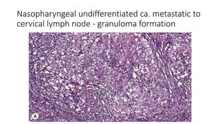 Nasopharyngeal Carcinoma Histology