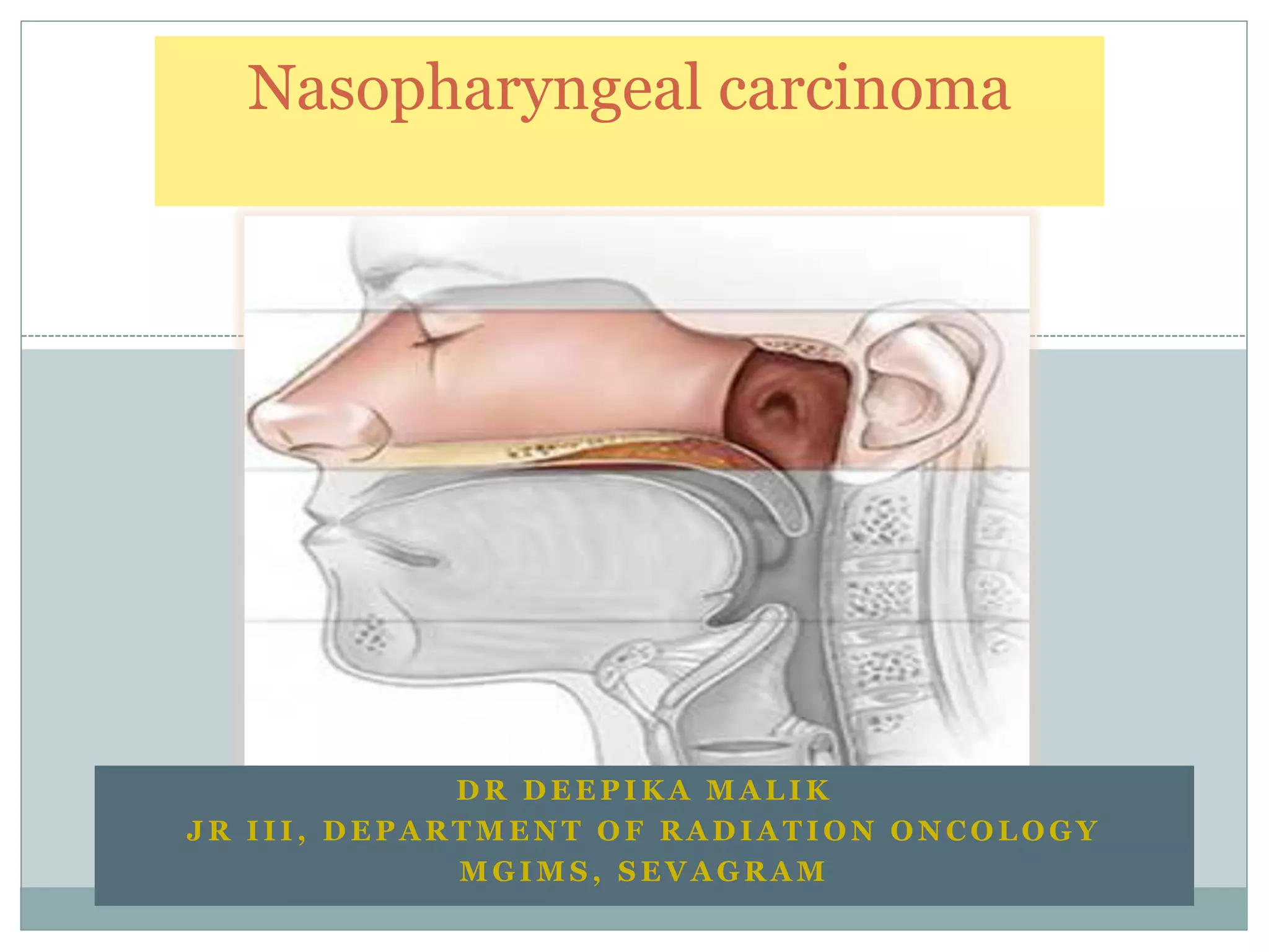 Nasopharyngeal cancer | PPTX