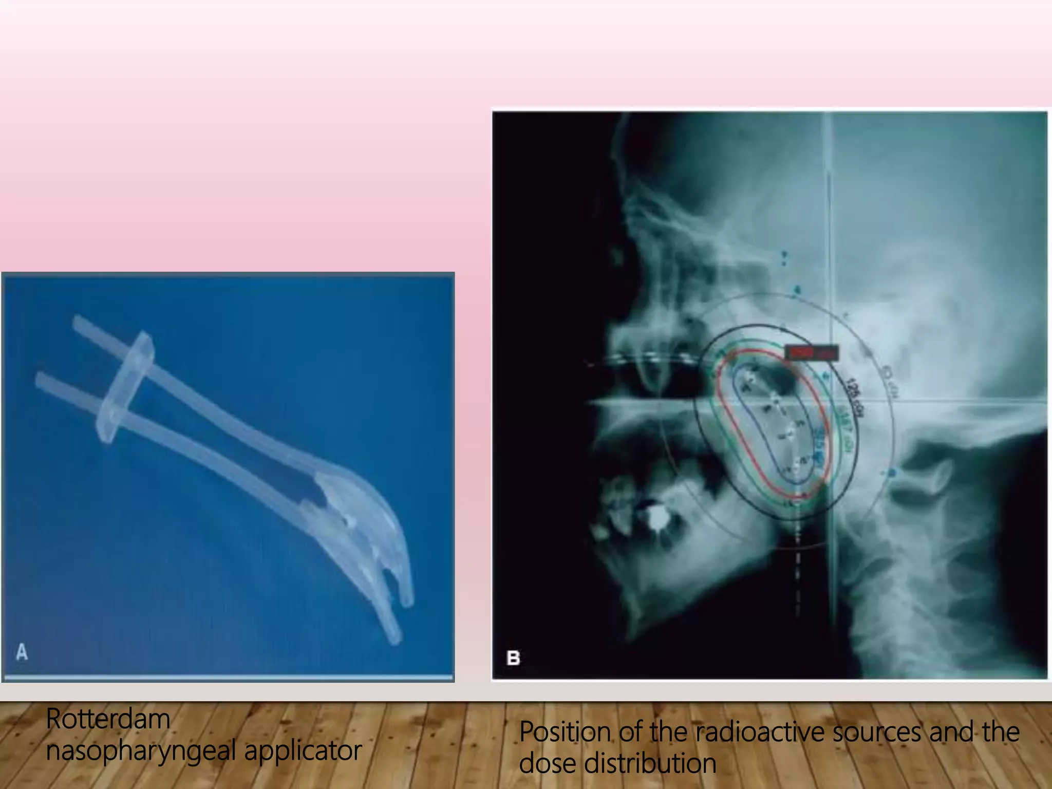 Nasopharynx rt techniques | PPTX