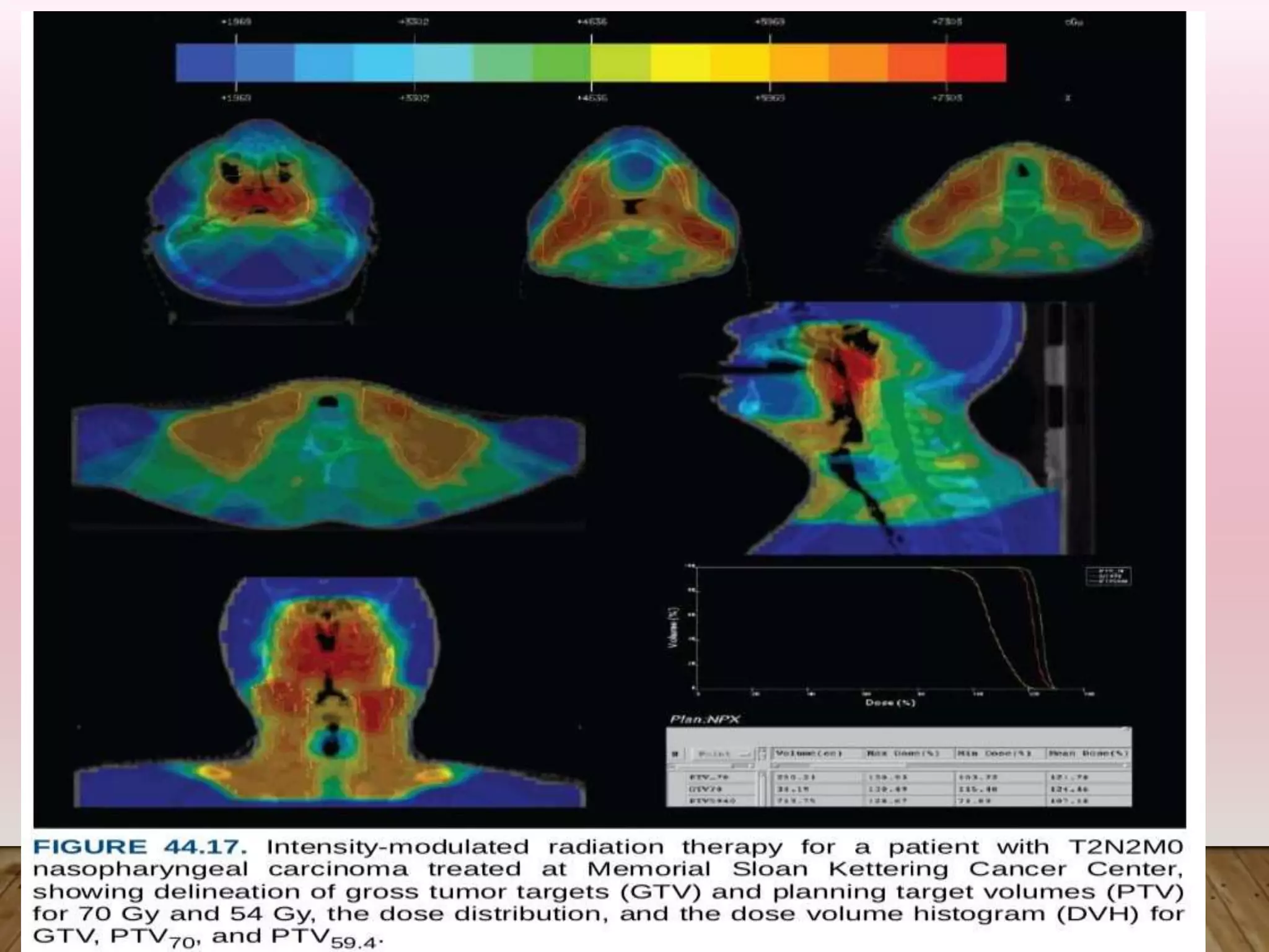 Nasopharynx rt techniques | PPTX