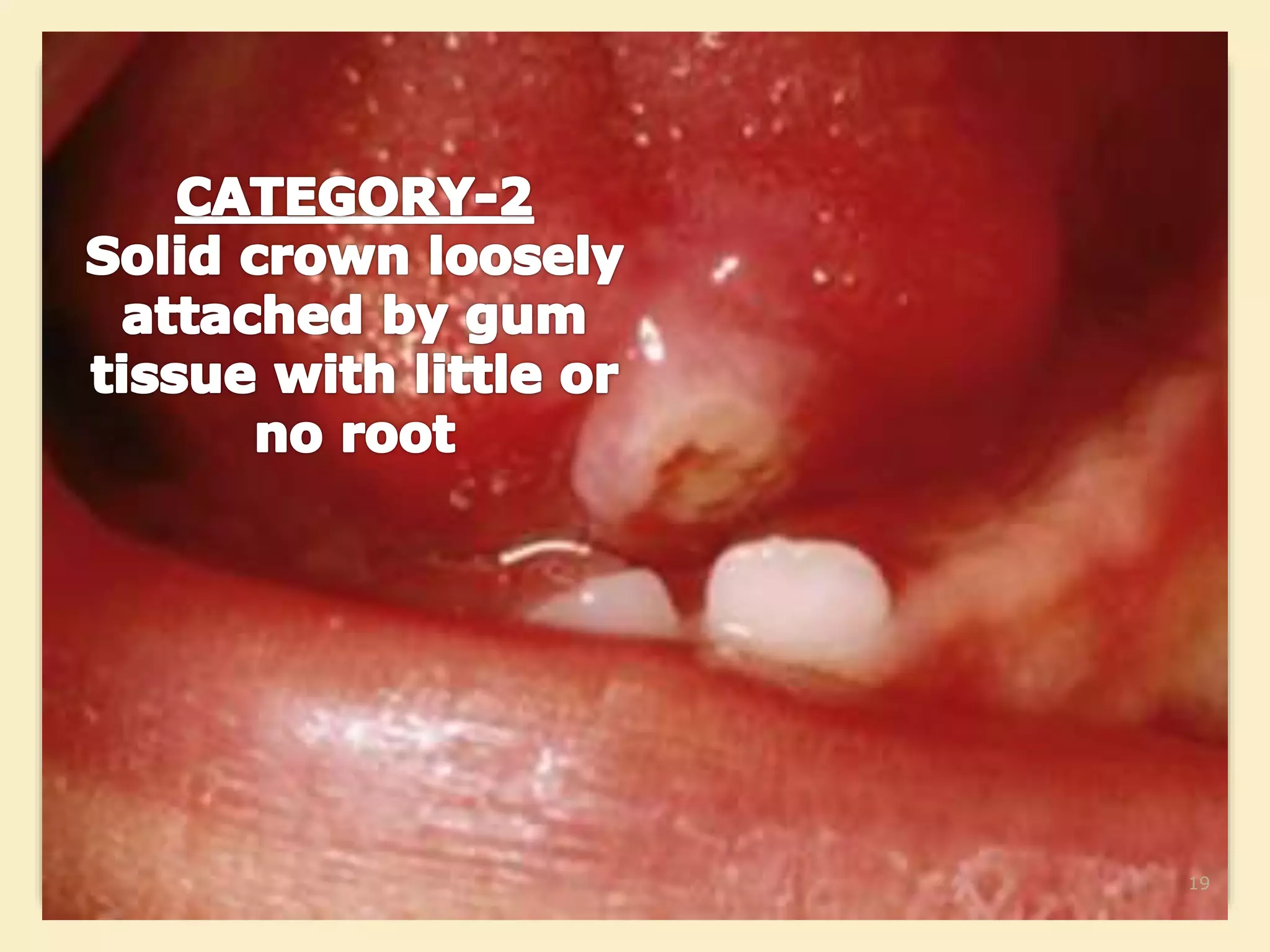 Natal and neonatal teeth | PPTX