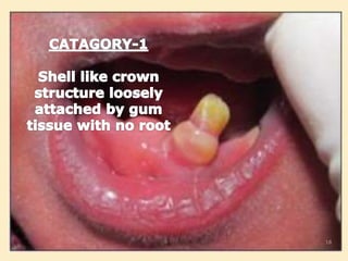 Natal and neonatal teeth | PPTX