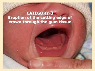 Natal and neonatal teeth | PPTX