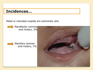 Natal and neonatal teeth | PPTX