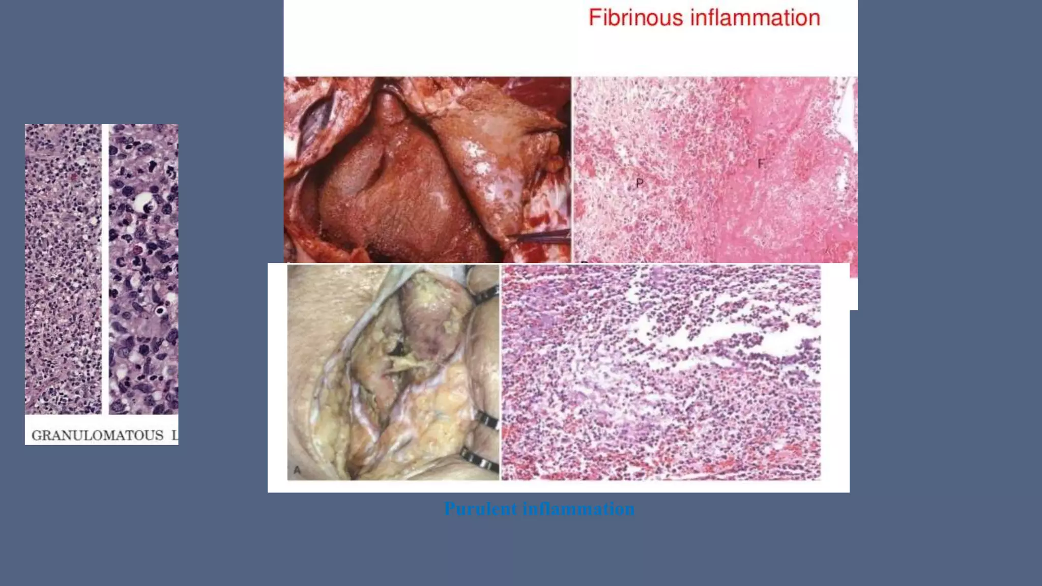 INFLAMMATION,types,morphological patterns,acute inflammation,chronic ...