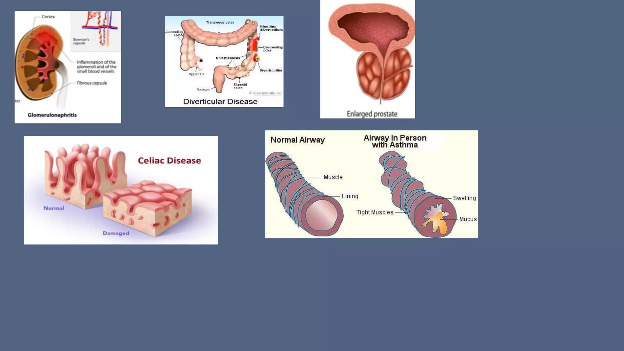 INFLAMMATION,types,morphological patterns,acute inflammation,chronic ...