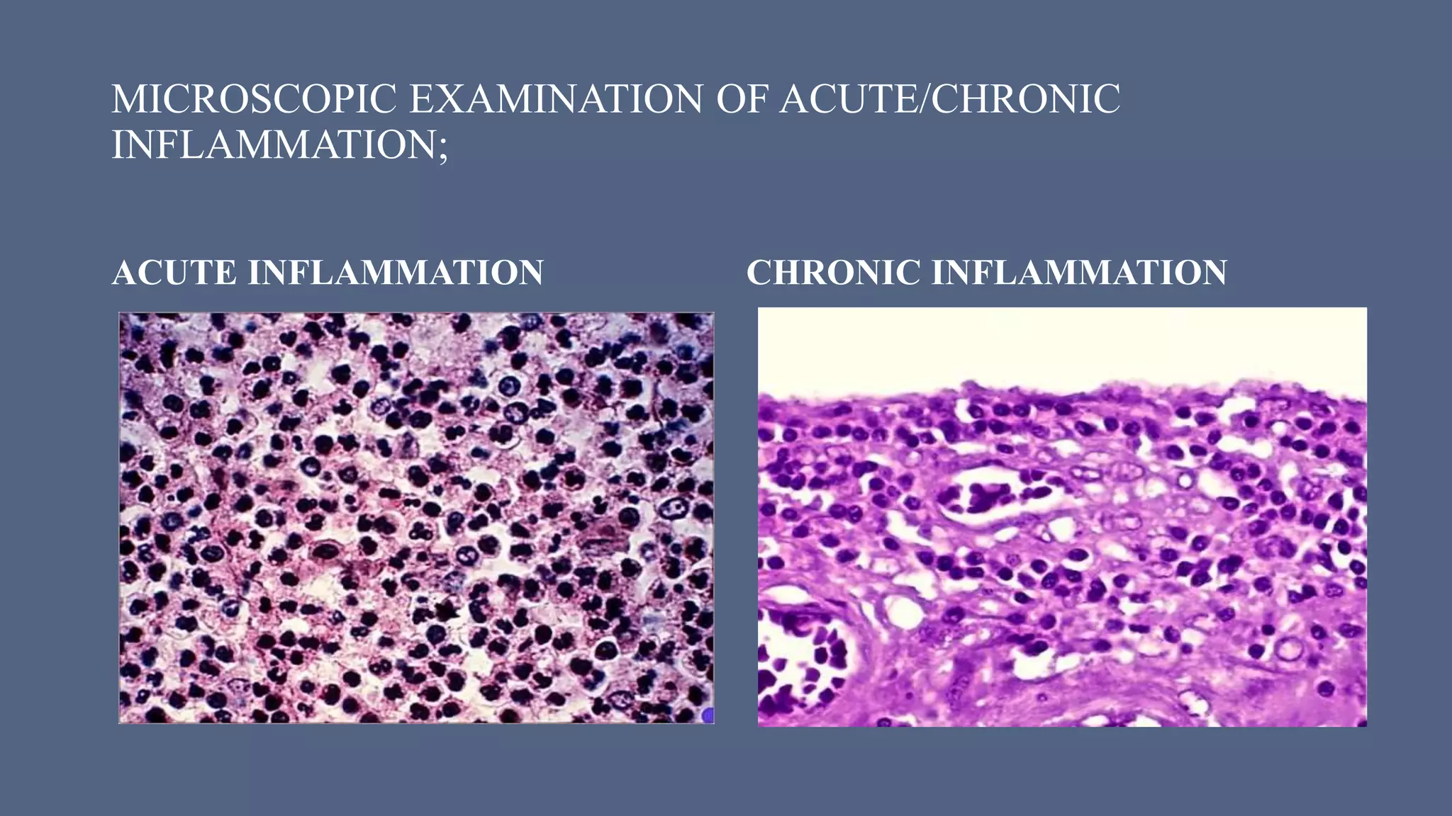 INFLAMMATION,types,morphological patterns,acute inflammation,chronic ...