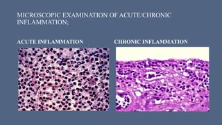 INFLAMMATION,types,morphological patterns,acute inflammation,chronic ...
