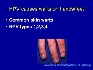 HPV: What is it? What does it do? | PPT