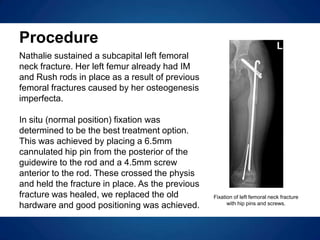 Nathalie: Osteogenesis Imperfecta (Type IV) Case Study | PDF | Death ...