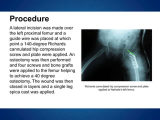Nathalie: Osteogenesis Imperfecta (Type IV) Case Study | PDF