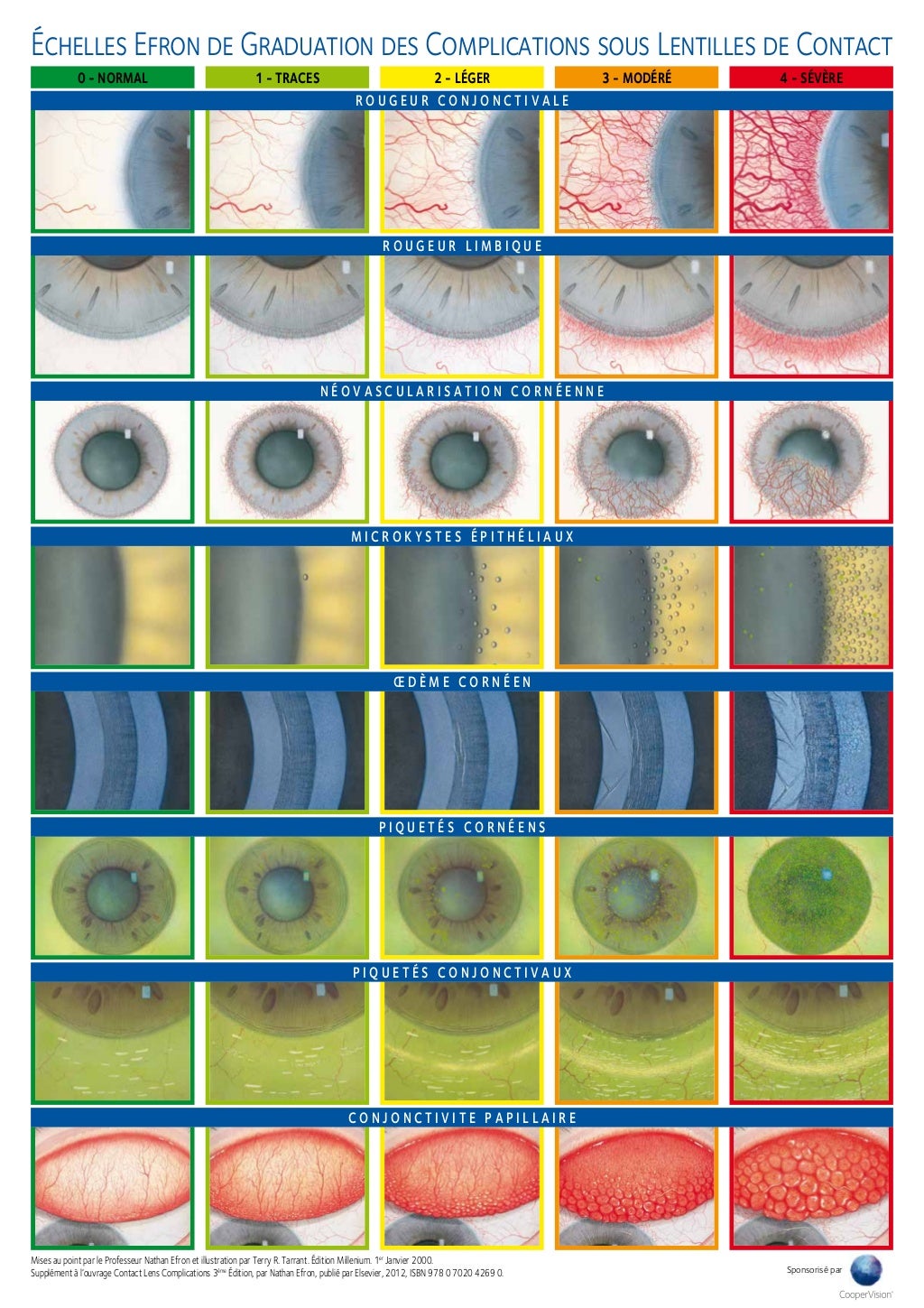 Echelle de gradation de Nathan Efron - Contactologie