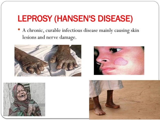 NATIONAL LEPROSY ERADICATION PROGRAMME.pptx