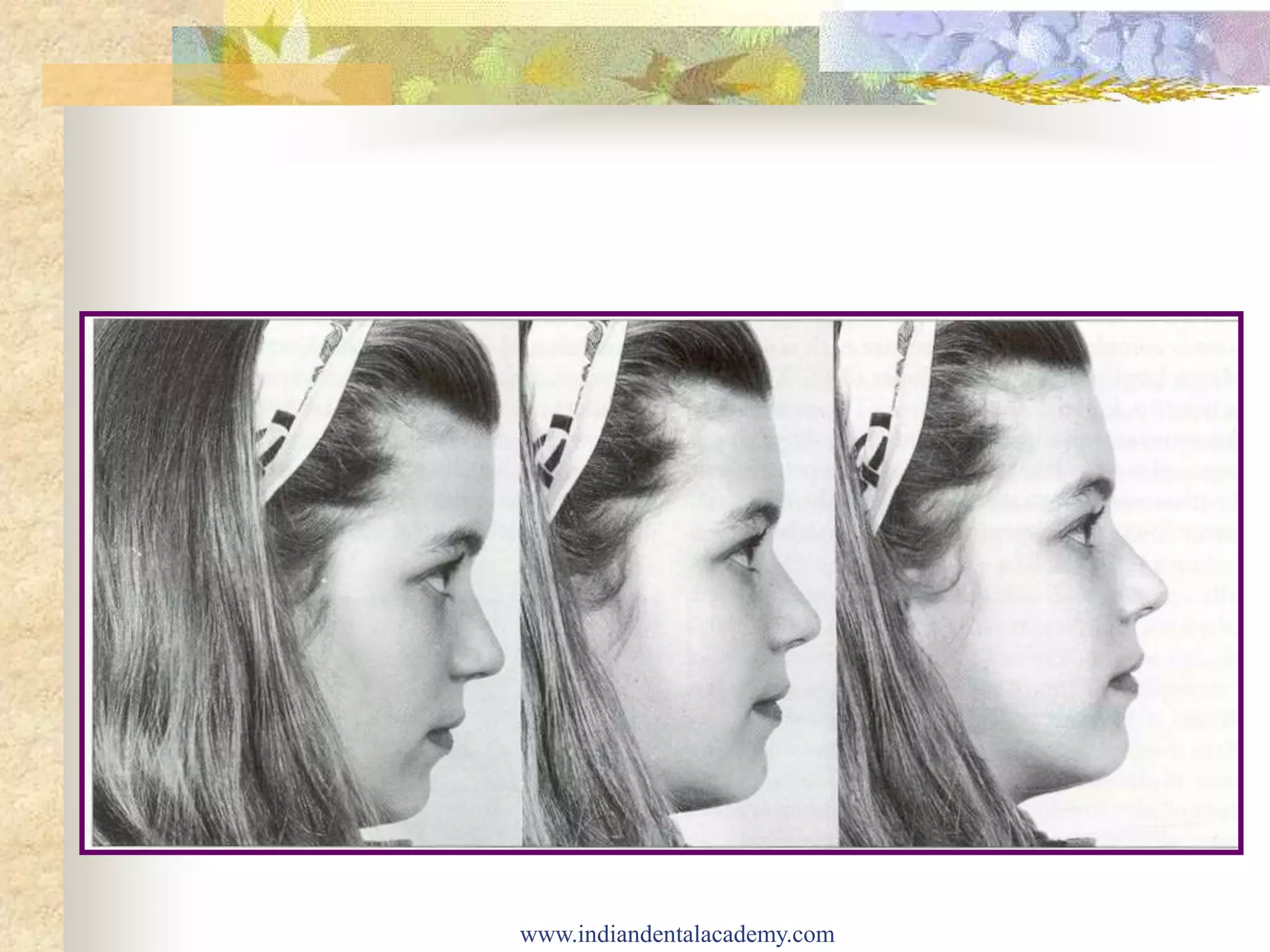 Natural head position | PPT