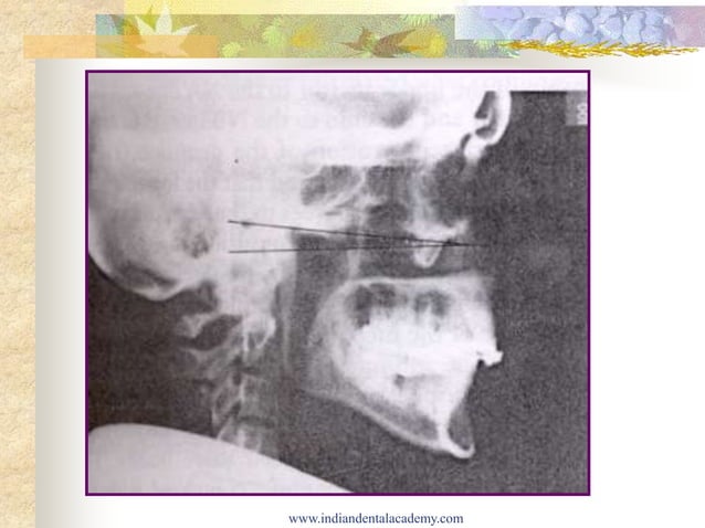 Natural head position | PPT